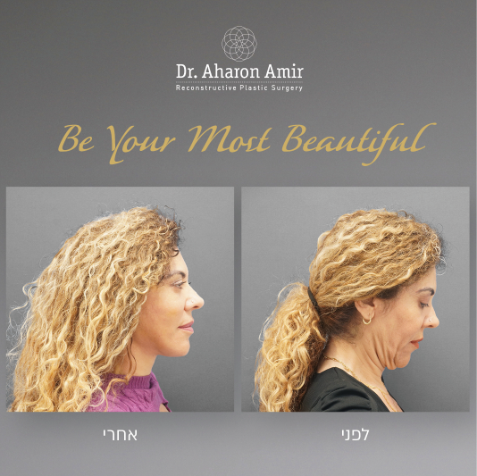 האם ניתן לשלב הליכים קוסמטיים נוספים עם ניתוח הרמת פנים? - Dr Aharon Amir- רפואה אסתטית